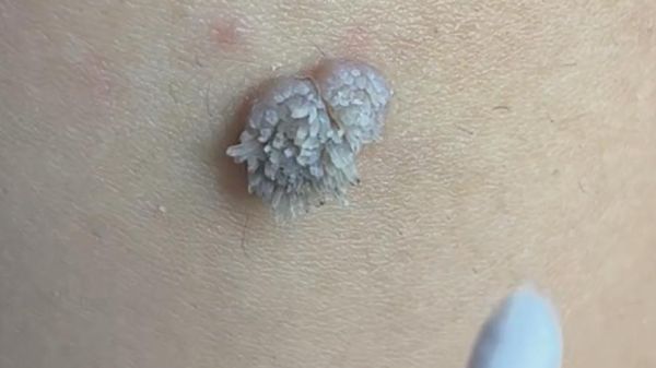 菜花状赘生物图片_是尖锐湿疣吗-第1张图片-山城妙识