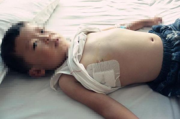 鸡胸病图片_鸡胸病怎么治疗-第3张图片-山城妙识 鸡胸病图片_鸡胸病怎么治疗-第3张图片-山城妙识