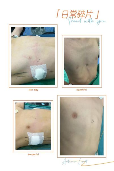 鸡胸病图片_鸡胸病怎么治疗-第2张图片-山城妙识 鸡胸病图片_鸡胸病怎么治疗-第2张图片-山城妙识