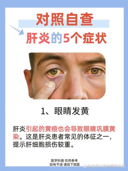 女性肝病早期有哪些症状_肝病征兆怎么判断-第1张图片-山城妙识 女性肝病早期有哪些症状_肝病征兆怎么判断-第1张图片-山城妙识