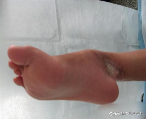 马蹄足能治好吗_马蹄足手术费用多少钱-第1张图片-山城妙识