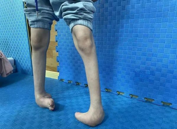 马蹄足能治好吗_马蹄足手术费用多少钱-第3张图片-山城妙识