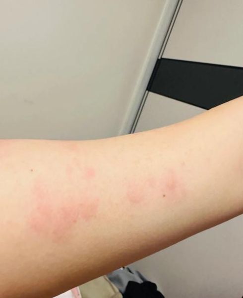 吃海鲜过敏是什么原因_海鲜过敏症状有哪些-第2张图片-山城妙识