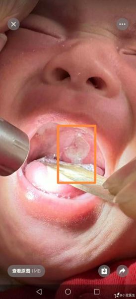 口腔溃疡中间白色是啥东西_溃疡白膜多久脱落-第1张图片-山城妙识