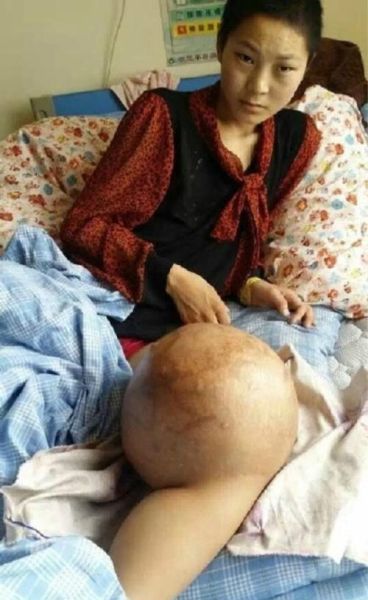 骨肉瘤图片怎么看_早期症状识别-第2张图片-山城妙识