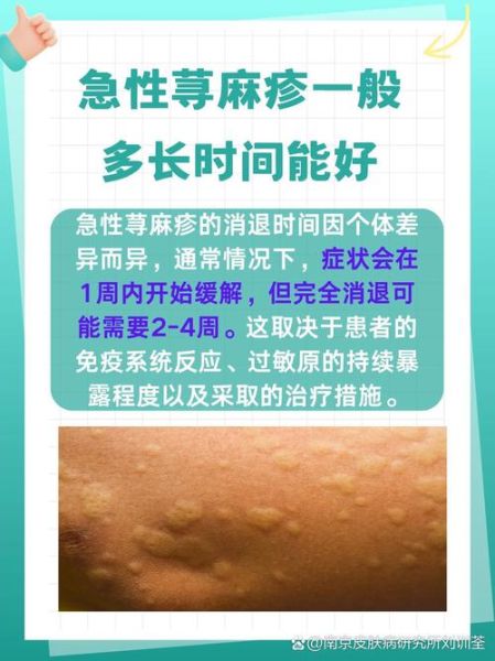 荨麻疹不管它会自愈吗_荨麻疹不治疗多久能好-第2张图片-山城妙识 荨麻疹不管它会自愈吗_荨麻疹不治疗多久能好-第2张图片-山城妙识