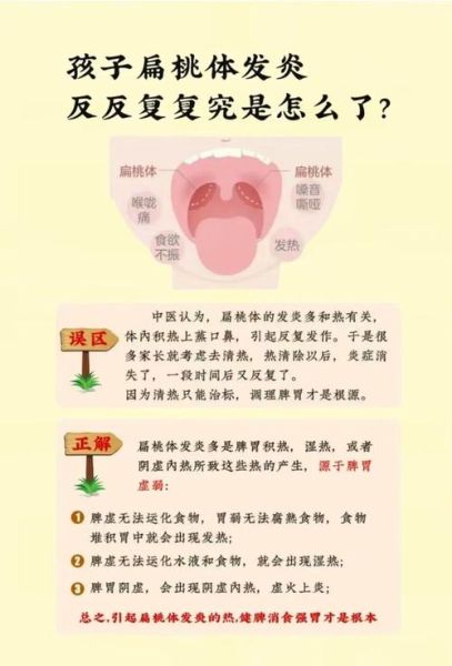 扁桃体发炎一般几天好_扁桃体发炎多久能好-第2张图片-山城妙识