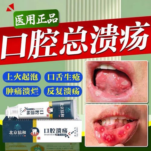 嘴上起泡摸牙膏管用吗_牙膏能快速去泡吗-第1张图片-山城妙识