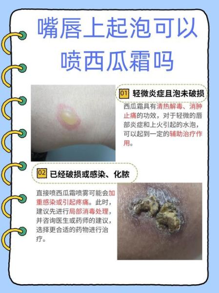 嘴唇上火起泡涂牙膏有用吗_牙膏能去火泡吗-第1张图片-山城妙识