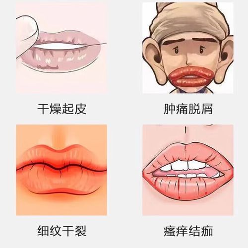 红霉素软膏可以涂嘴唇吗_嘴唇干裂能用红霉素软膏吗-第1张图片-山城妙识