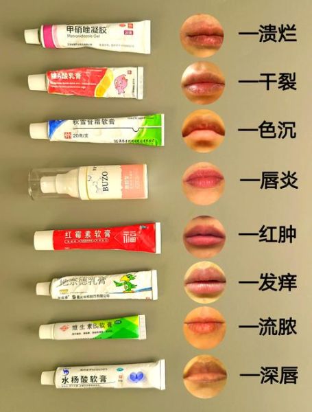 红霉素软膏可以涂嘴唇吗_嘴唇干裂能用红霉素软膏吗-第2张图片-山城妙识