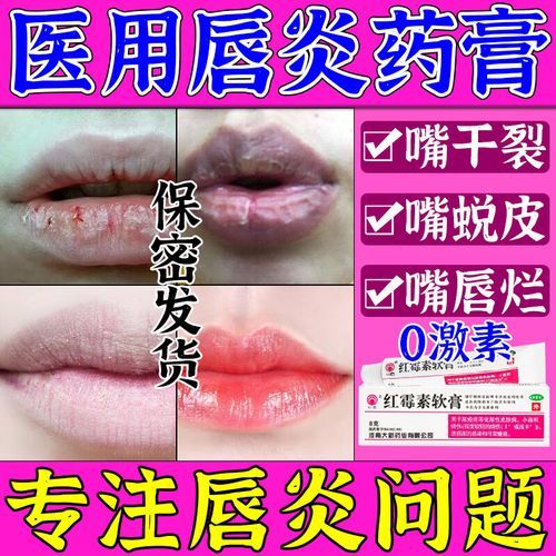 红霉素软膏可以涂嘴唇吗_嘴唇干裂能用红霉素软膏吗-第3张图片-山城妙识