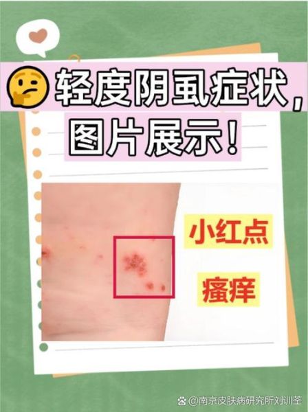 虱怎么读_虱子读音是什么-第2张图片-山城妙识