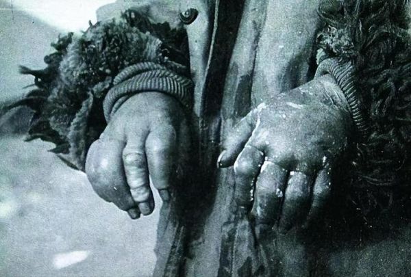 芥子气是什么_芥子气中毒怎么办-第1张图片-山城妙识