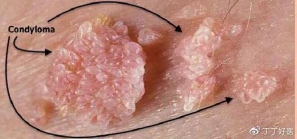 小菜花是什么病_小菜花初期症状图片-第3张图片-山城妙识