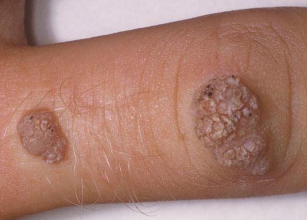 小菜花是什么病_小菜花初期症状图片-第1张图片-山城妙识