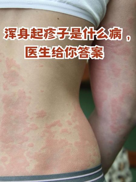 身上起红疹子很痒怎么办_常见疹子症状图片对照-第1张图片-山城妙识