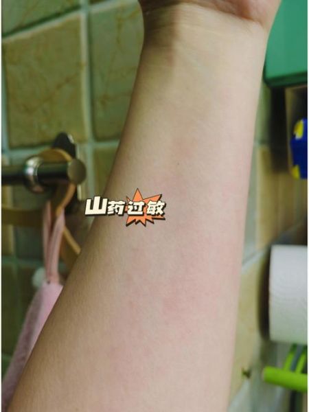 刮山药皮肤痒怎么快速止痒_山药粘液过敏怎么办-第3张图片-山城妙识