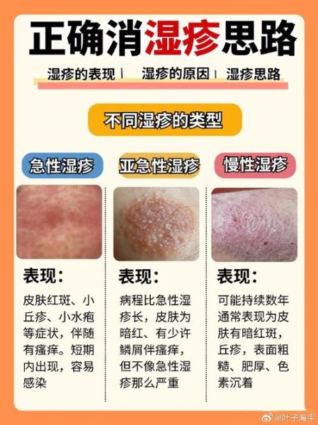 皮炎和湿疹的区别图片_怎么分辨-第3张图片-山城妙识