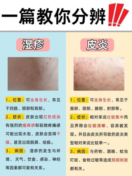 皮炎和湿疹的区别图片_怎么分辨-第1张图片-山城妙识