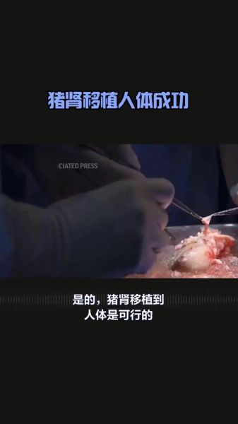 猪肾移植人体最新进展_猪肾移植人体能活多久-第1张图片-山城妙识