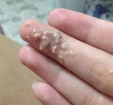 豆腐渣样白带图片_豆腐渣样白带是什么炎症-第1张图片-山城妙识