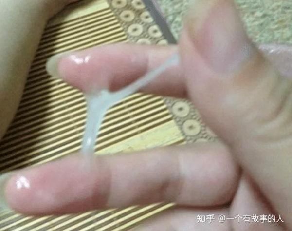 豆腐渣样白带图片_豆腐渣样白带是什么炎症-第2张图片-山城妙识