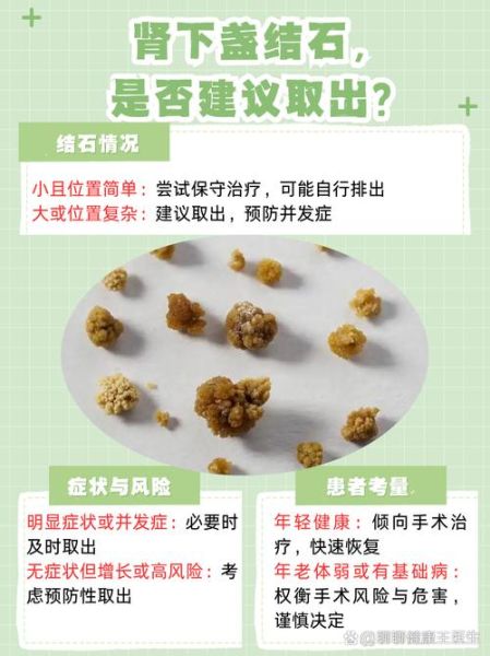 肾结石的早期症状_如何判断自己有肾结石-第3张图片-山城妙识