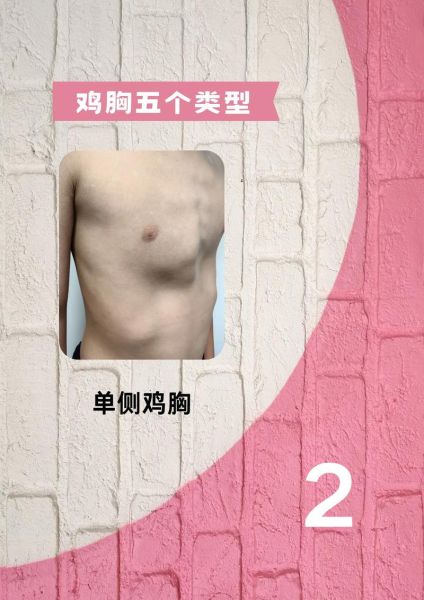小儿鸡胸图片_鸡胸矫正方法有哪些-第1张图片-山城妙识 小儿鸡胸图片_鸡胸矫正方法有哪些-第1张图片-山城妙识