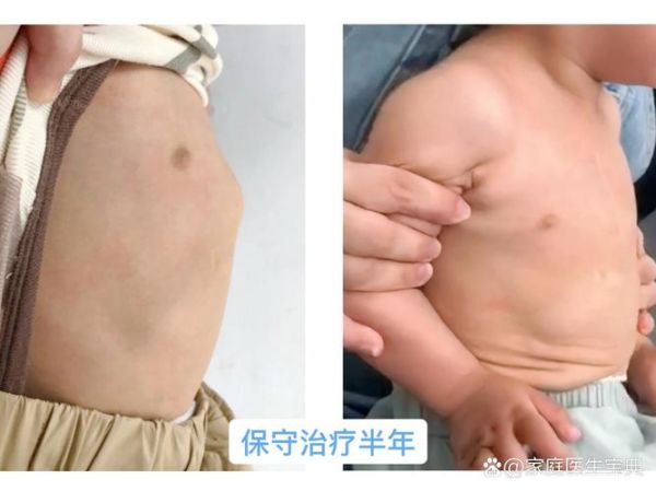 小儿鸡胸图片_鸡胸矫正方法有哪些-第3张图片-山城妙识 小儿鸡胸图片_鸡胸矫正方法有哪些-第3张图片-山城妙识