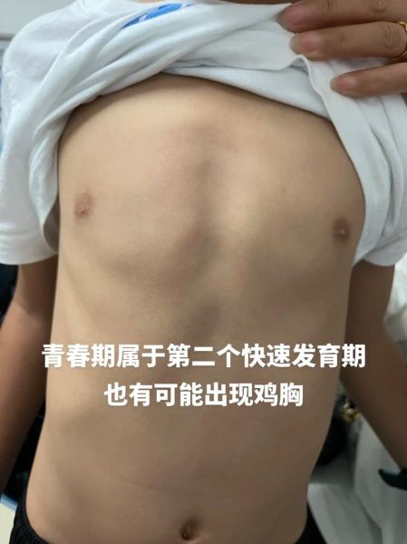 小儿鸡胸图片_鸡胸矫正方法有哪些-第2张图片-山城妙识 小儿鸡胸图片_鸡胸矫正方法有哪些-第2张图片-山城妙识