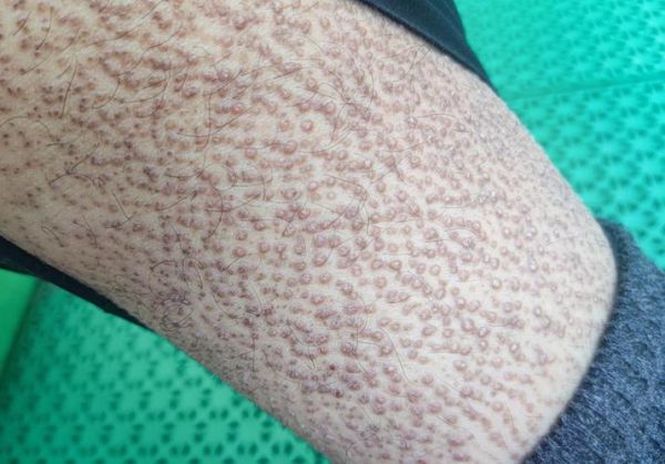 淀粉样变心肌病早期症状_淀粉样变心肌病能活多久-第2张图片-山城妙识