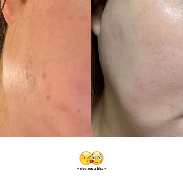 祛斑美白的最好方法_如何快速淡斑不反弹-第3张图片-山城妙识