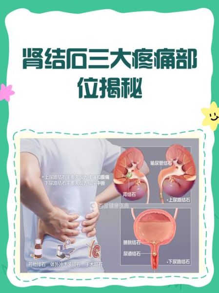 女性肾结石疼痛部位_女性肾结石哪里疼-第2张图片-山城妙识