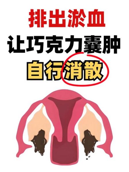 巧克力囊肿会癌变吗_巧克力囊肿多久复查一次-第1张图片-山城妙识