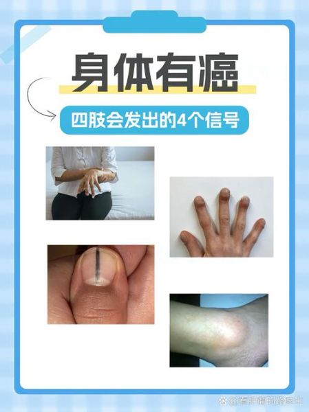 体内有癌的早期症状_如何判断体内有癌-第1张图片-山城妙识 体内有癌的早期症状_如何判断体内有癌-第1张图片-山城妙识