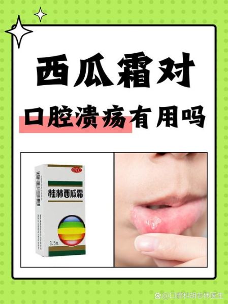 西瓜霜治疗口腔溃疡的原理_西瓜霜为什么见效快-第1张图片-山城妙识