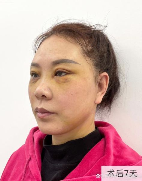 脸部拉皮手术过程图片_恢复期多久-第1张图片-山城妙识 脸部拉皮手术过程图片_恢复期多久-第1张图片-山城妙识