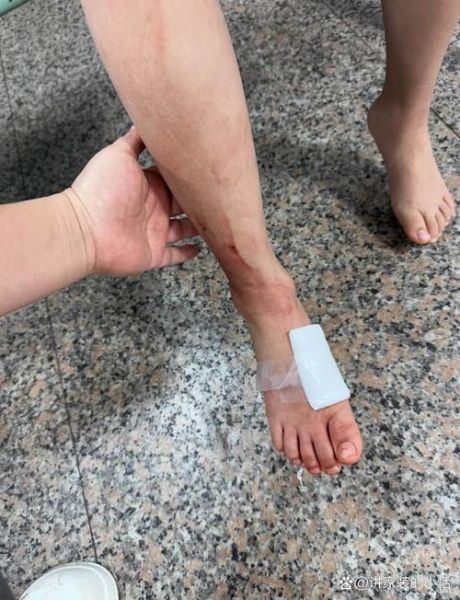 八角丁虫扎人后照片_被八角丁虫咬了怎么办-第2张图片-山城妙识 八角丁虫扎人后照片_被八角丁虫咬了怎么办-第2张图片-山城妙识