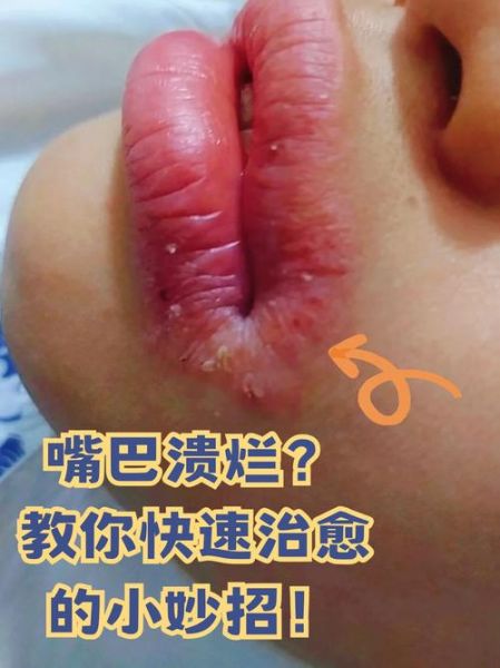 口腔溃疡怎么快速好_一夜治愈妙法的真相-第2张图片-山城妙识
