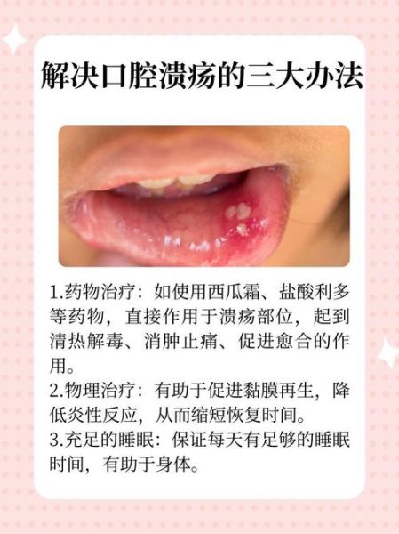 口腔溃疡怎么快速好_治口腔溃疡的偏方有哪些-第1张图片-山城妙识