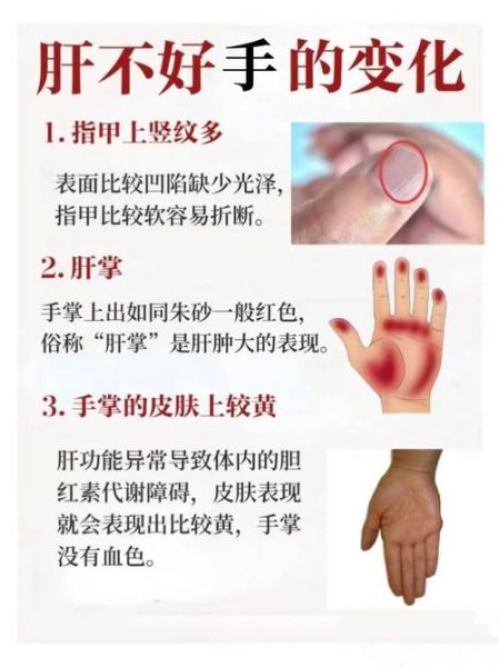肝不好的人脚有什么症状_如何通过脚部判断肝脏问题-第1张图片-山城妙识