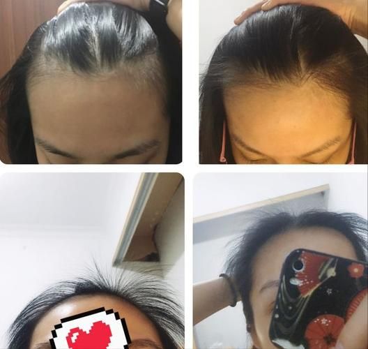 飞机打多了会脱发吗_多久能恢复-第2张图片-山城妙识