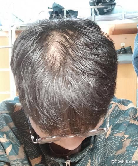 飞机打多了会脱发吗_多久能恢复-第3张图片-山城妙识