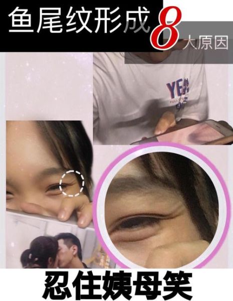 长鱼尾纹了怎么办_鱼尾纹怎么消除-第1张图片-山城妙识