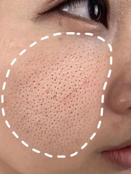 芝麻毛孔粗大怎么办_如何改善芝麻毛孔-第1张图片-山城妙识