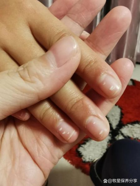 严重缺锌的手指甲图片_指甲有白点是缺锌吗-第3张图片-山城妙识