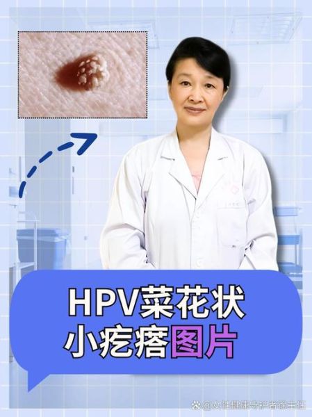 男性菜花状疣不痛不痒_会自愈吗-第2张图片-山城妙识 男性菜花状疣不痛不痒_会自愈吗-第2张图片-山城妙识