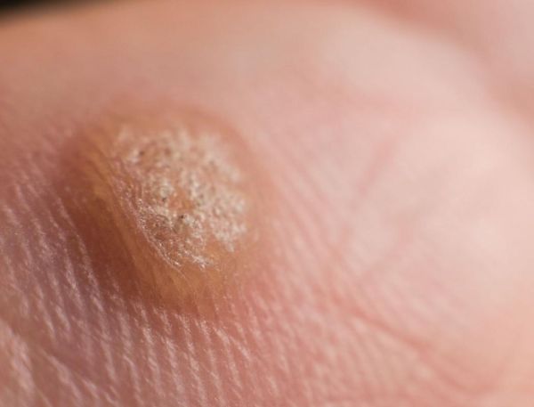 男性菜花状疣不痛不痒_会自愈吗-第3张图片-山城妙识 男性菜花状疣不痛不痒_会自愈吗-第3张图片-山城妙识