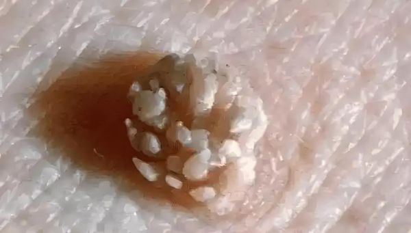 男性菜花状疣不痛不痒_会自愈吗-第1张图片-山城妙识 男性菜花状疣不痛不痒_会自愈吗-第1张图片-山城妙识